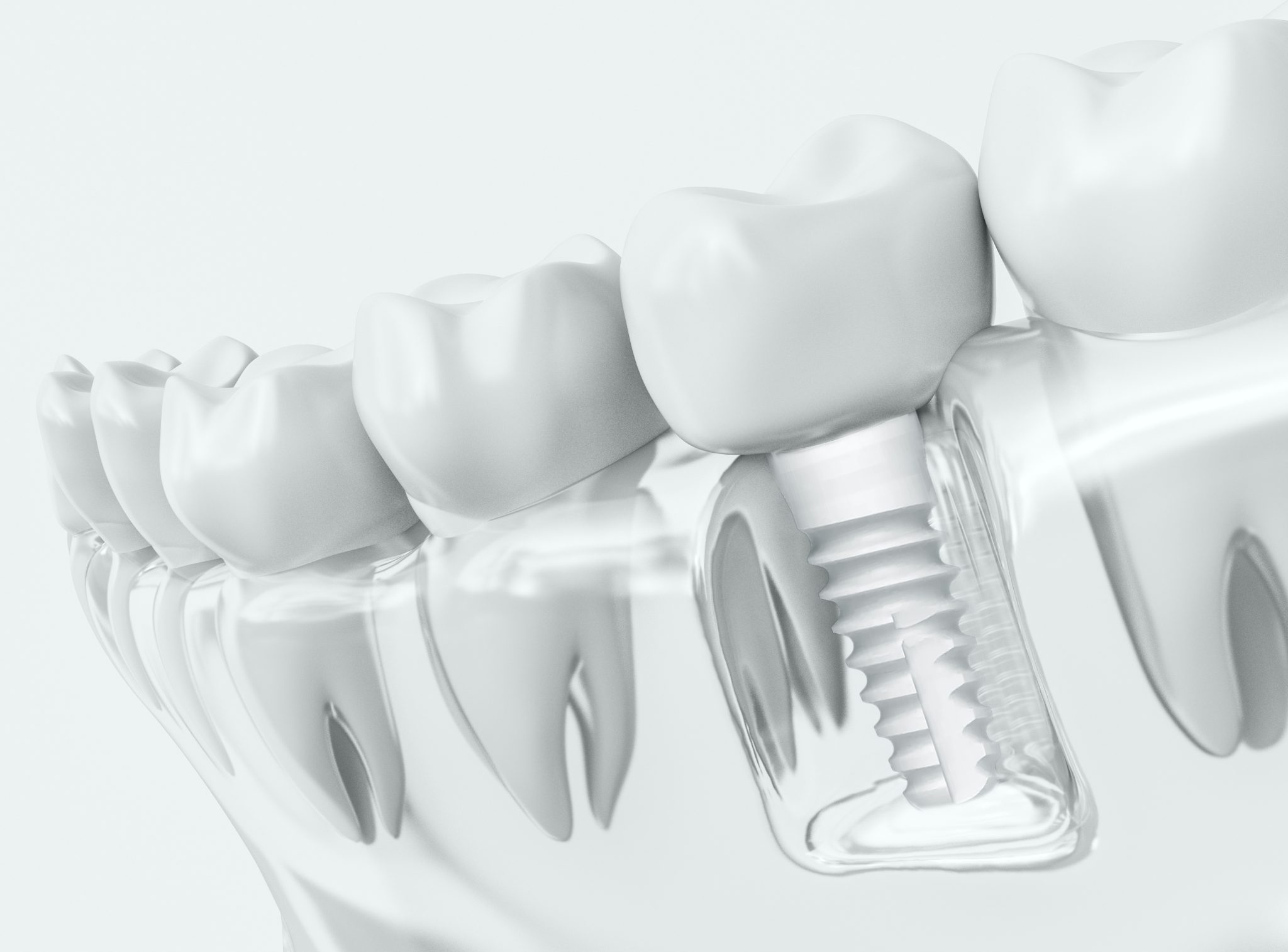 Before Anesthesia | Oral Surgeon in Marietta, GA