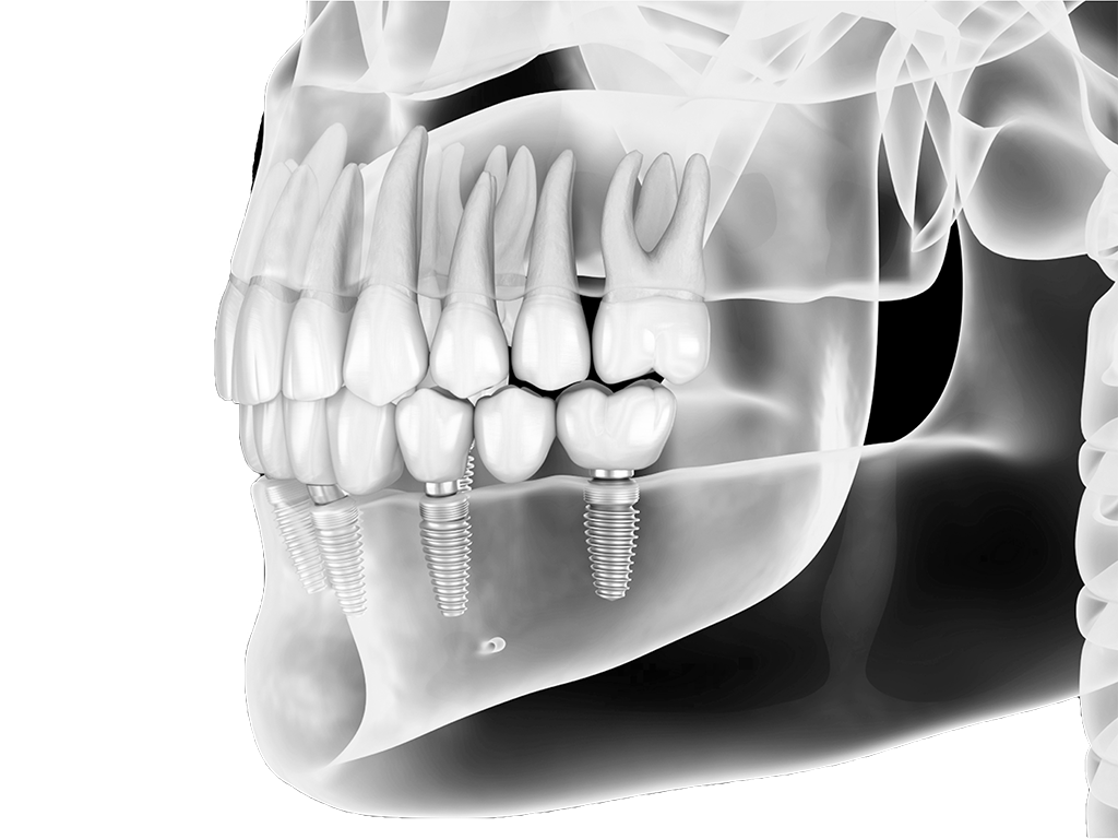Dental Implant Post Op Oral Surgeon In Marietta GA Dental Implant Post Op Oral Surgeon In Marietta GA
